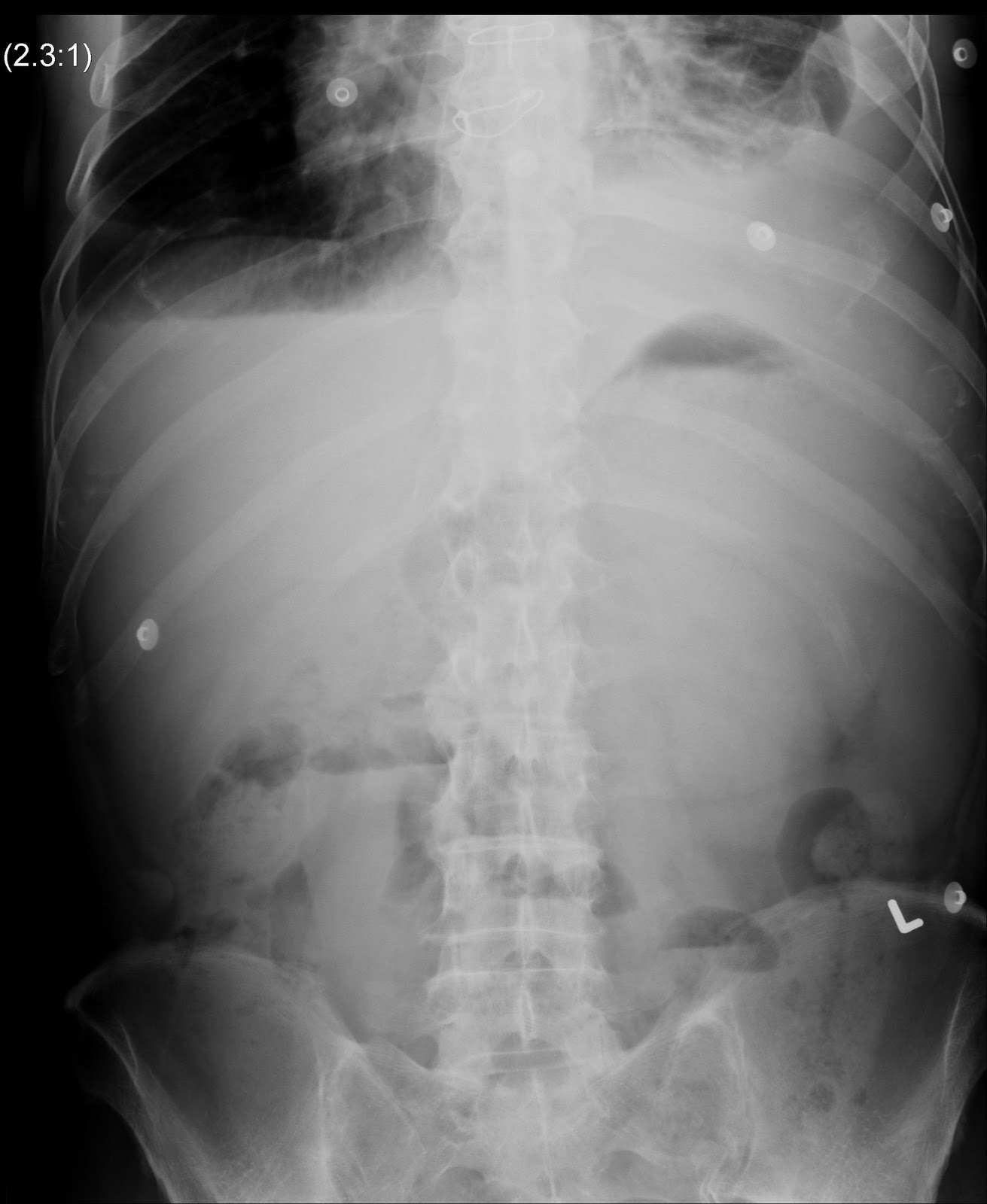 Post Gad Closed Loop Obstruction