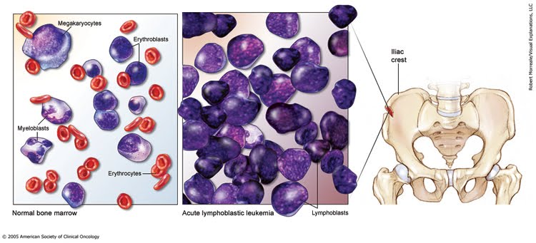 my lense's story: CML (cancer darah) also known as leukimia