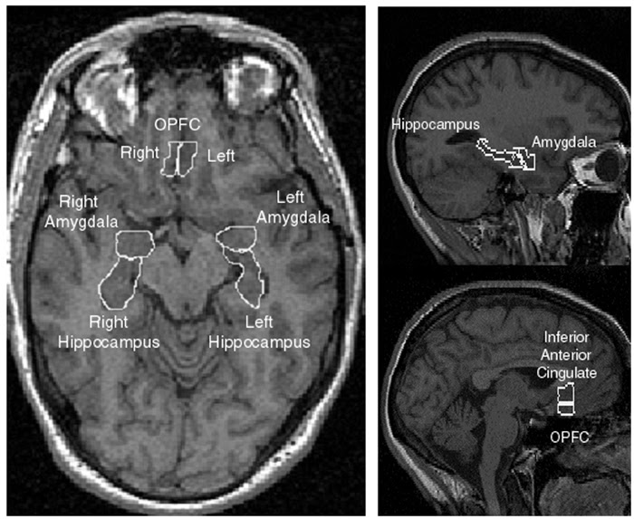 Antipodea: Amygdala Volume and Social Network Size in Humans