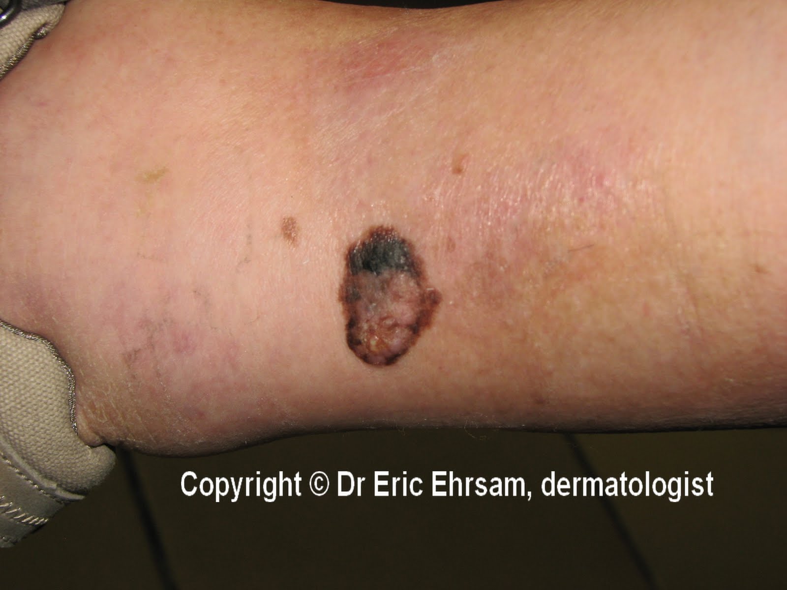 dermoscopy: What is this lesion on a leg (2nd case)