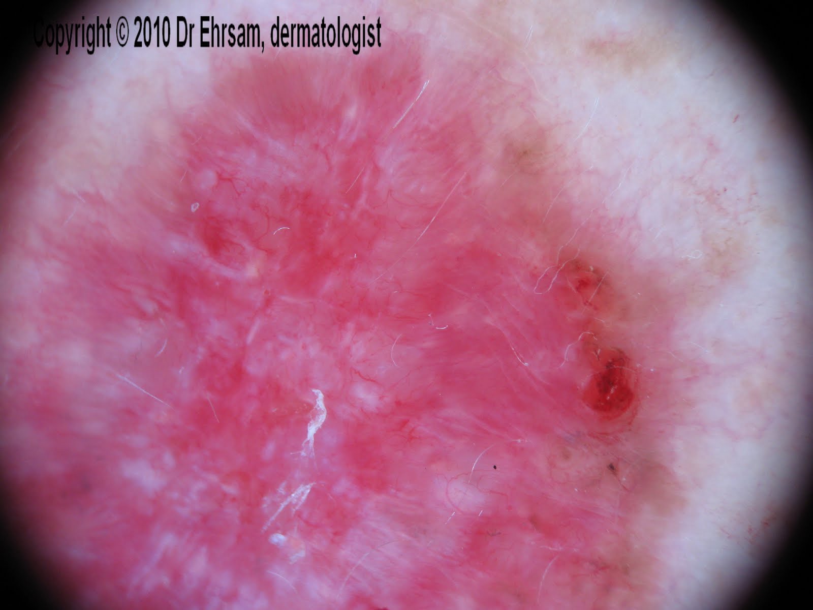 dermoscopy: September 2010