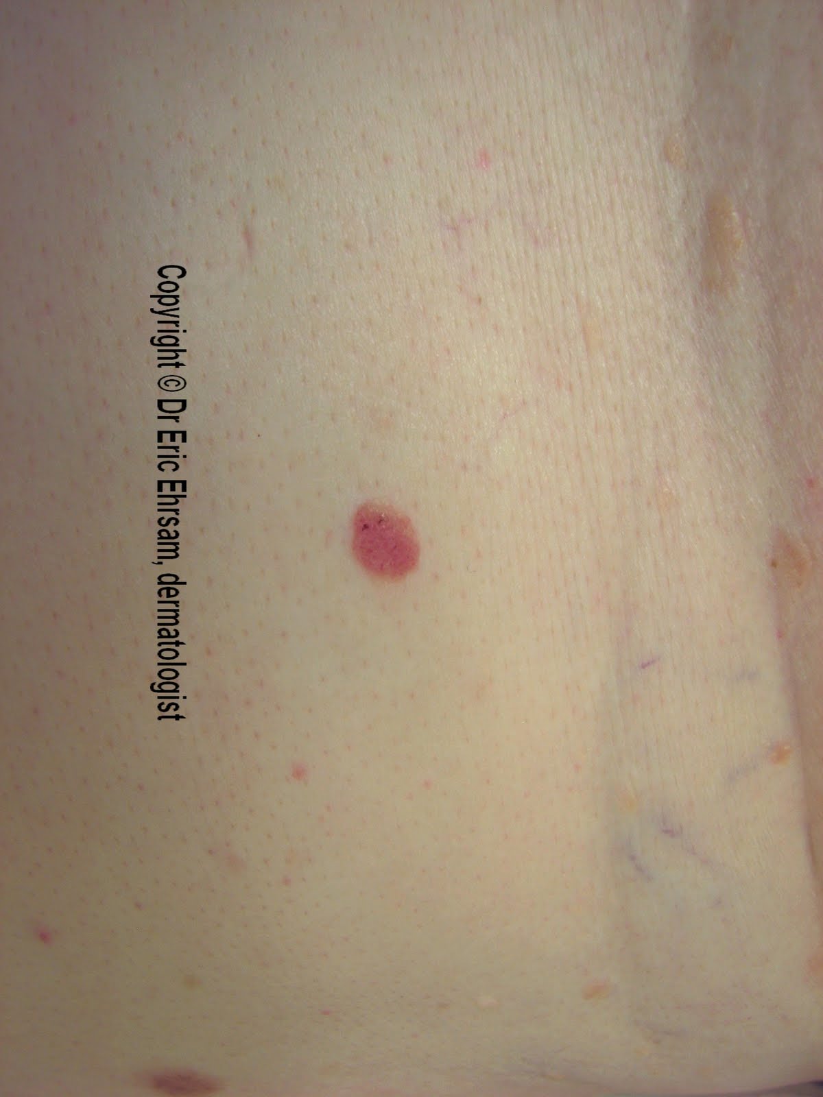 Dermoscopy A Red Tumor