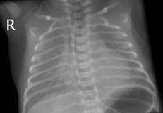 CONTOH ASKEP: ASKEP BAYI DENGAN RDS