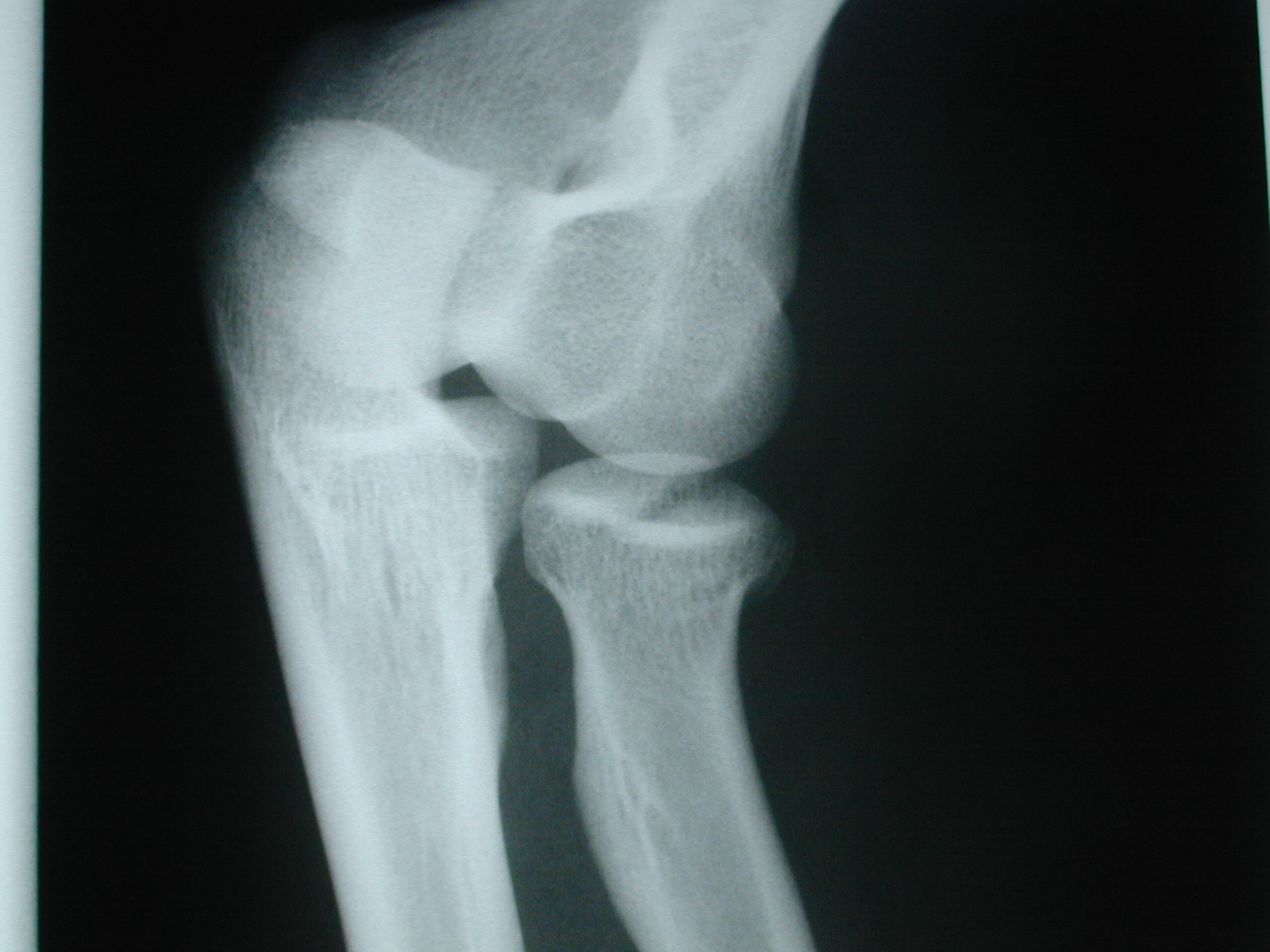 Unidad Cirugia de Mano y Reconstructiva La Plata-Argentina: Fractura de ...