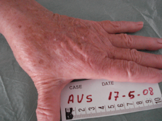 Úlceras de piel: Fotos Caso 1