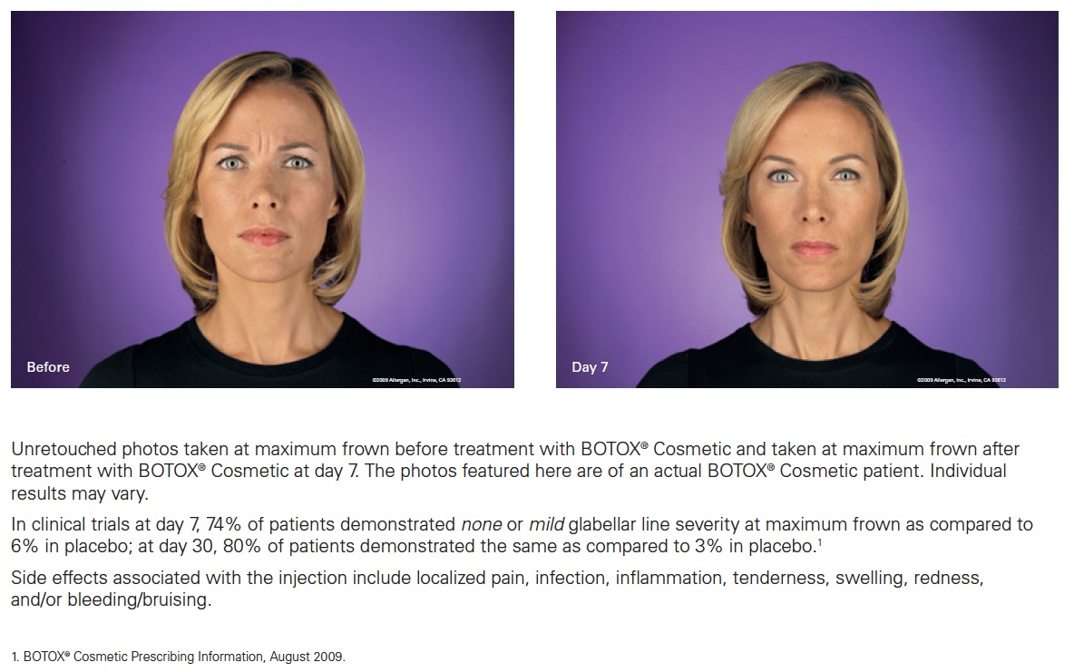 The Woodlands Plastic Surgeon® : Botox Injection Before & After Photos