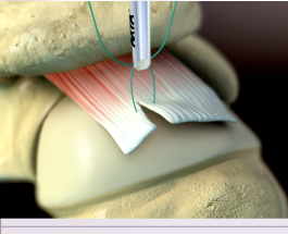 maya | modeling | animation: Proposal: Below Knee Amputation - Surgical ...