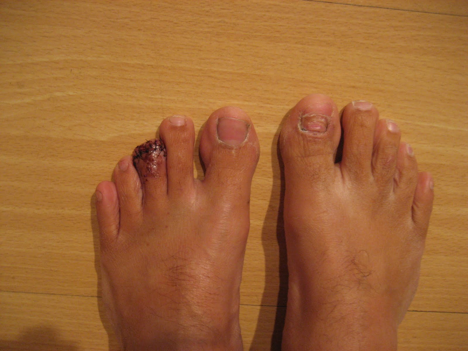 kneetopia: Gone baby gone - middle toe partial amputation