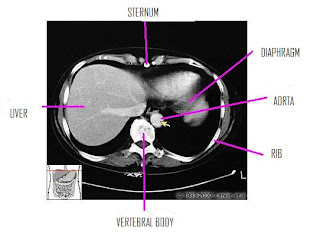 CT2009: LABELED CT ABDOMEN