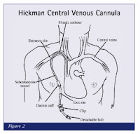 Ovarian Cancer and Me: More Chemotherapy and a Hickman Line