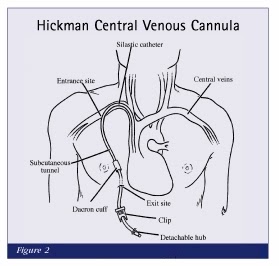 Ovarian Cancer and Me: More Chemotherapy and a Hickman Line