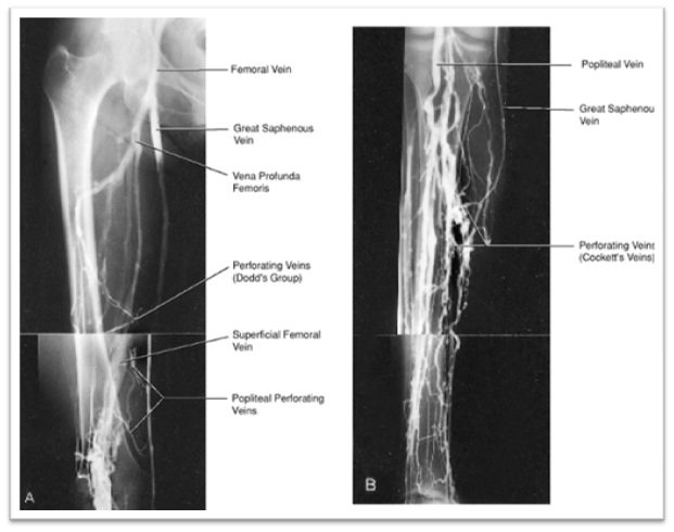 BELAJAR RADIOLOGI INTERVENSI: Prosedur Phlebography