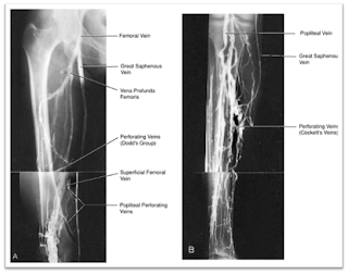 BELAJAR RADIOLOGI INTERVENSI: Prosedur Phlebography