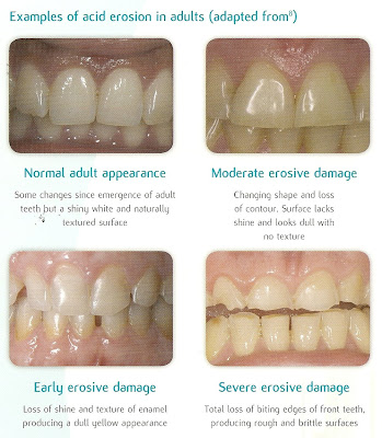 Making People Smile: Tooth Erosion due to Acidic Foods