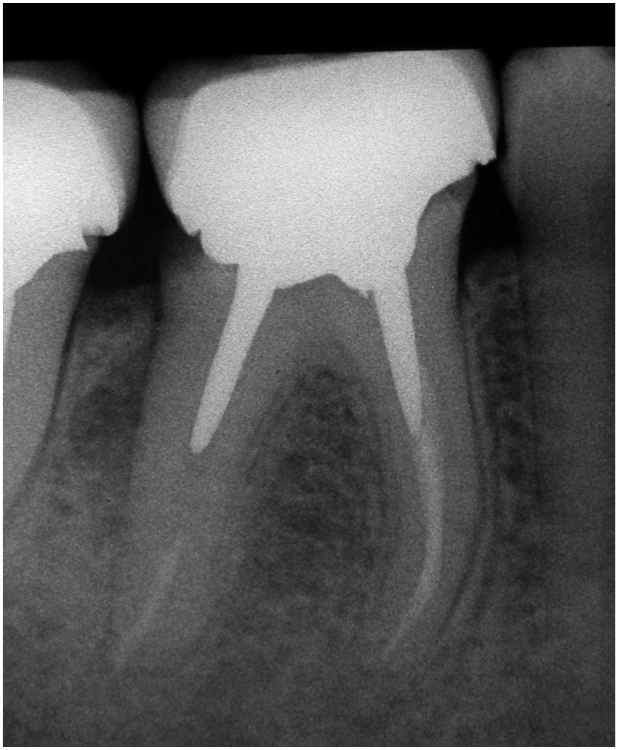 BLOG DE LA CATEDRA DE ENDODONCIA USAL/AOA: La obturación del conducto ...