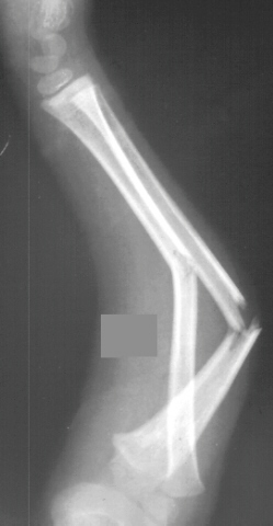 Logan :): Broken Bones