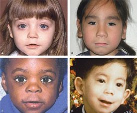 Children's House International: Focus on Special Needs...Fetal Alcohol ...