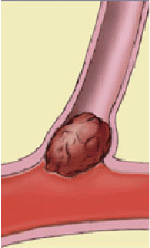 Heart Attack and Stroke: Stroke, Heart Attack and Embolism