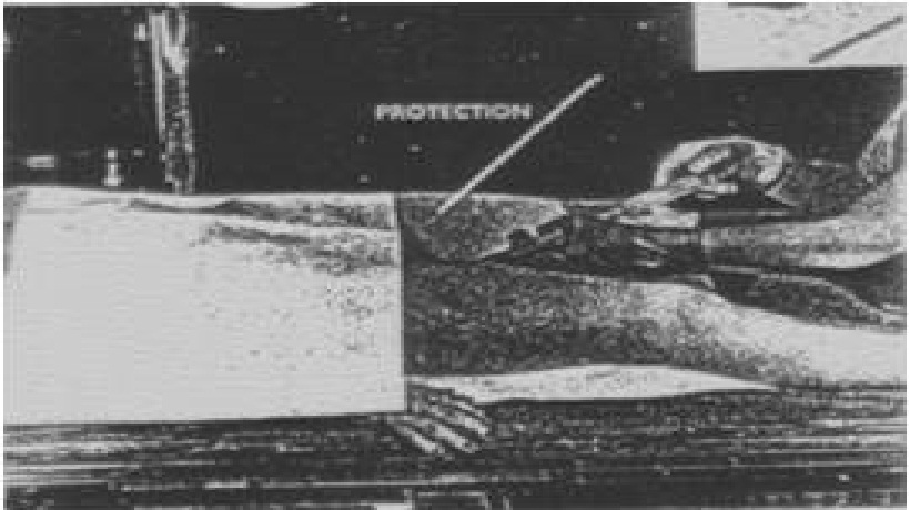 Cafe Radiologi: Teknik Radiografi HSG (Histerosalpingografi)