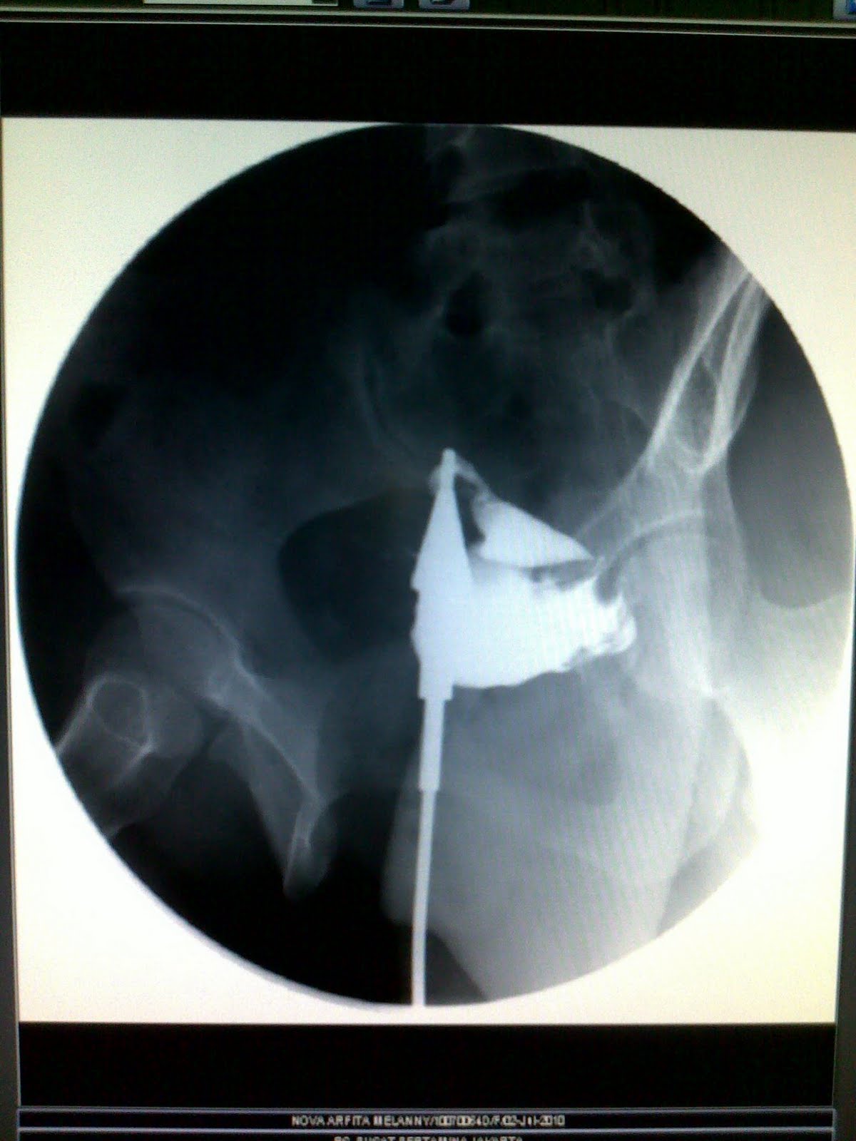 Cafe Radiologi: Teknik Radiografi HSG (Histerosalpingografi)