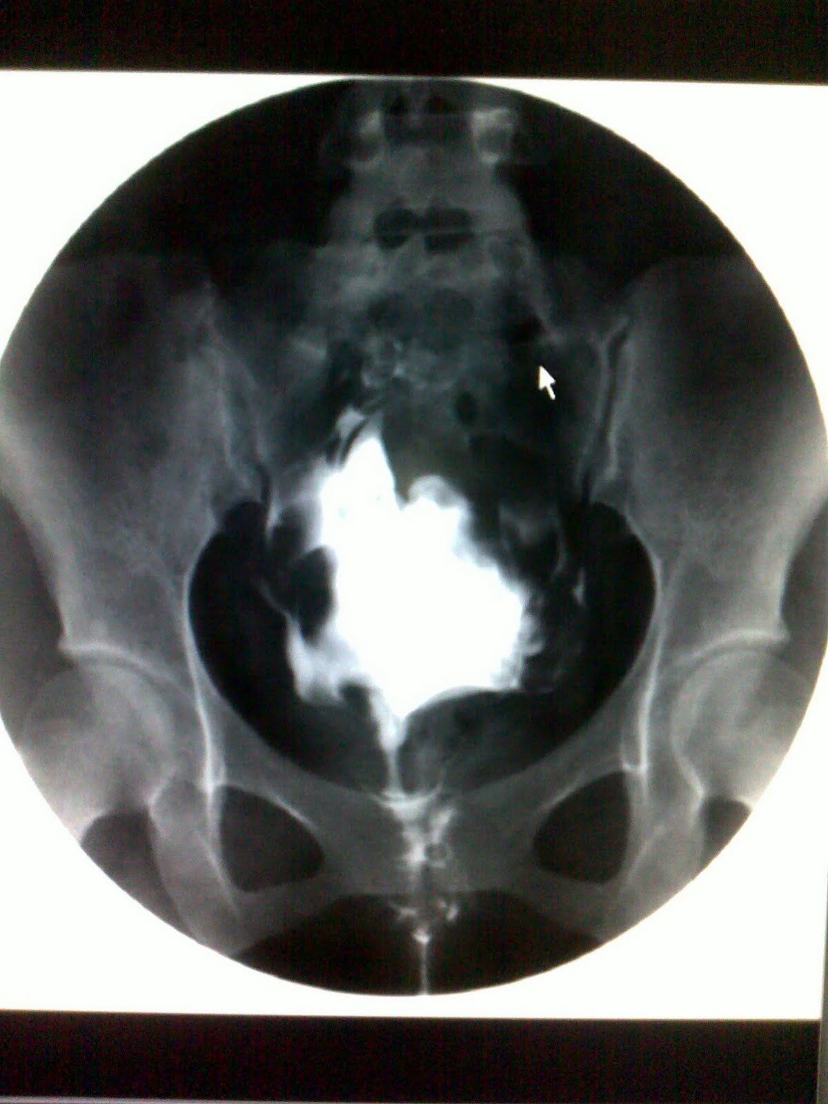 Cafe Radiologi: Teknik Radiografi HSG (Histerosalpingografi)