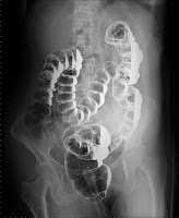 Cafe Radiologi: Teknik Pemeriksaan Kontras "Colon In Loop"