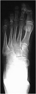 Cafe Radiologi: Teknik Pemeriksaan Ossa Pedis proyeksi AP ( foot AP ...