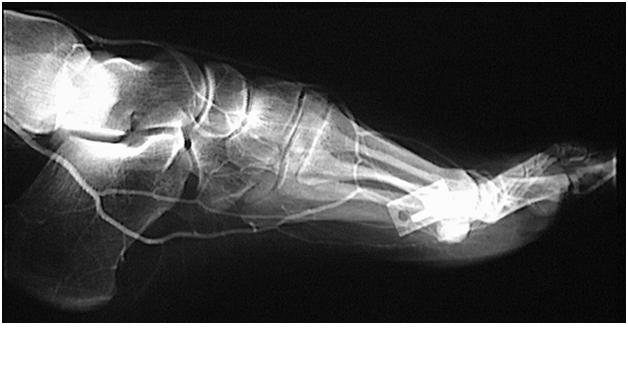 Cafe Radiologi: Teknik Pemeriksaan Ossa Pedis proyeksi Lateral ( foot ...