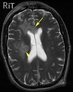 RiT radiology: Primary CNS Lymphoma (PCNSL)