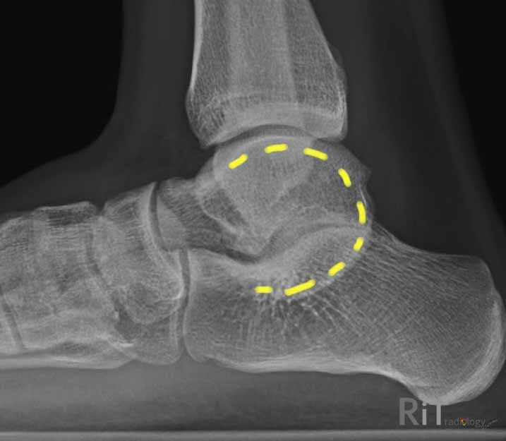 RiT radiology: C Sign of Talocalcaneal Coalition