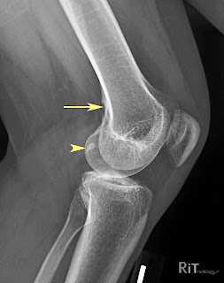 RiT radiology: Cortical Desmoid