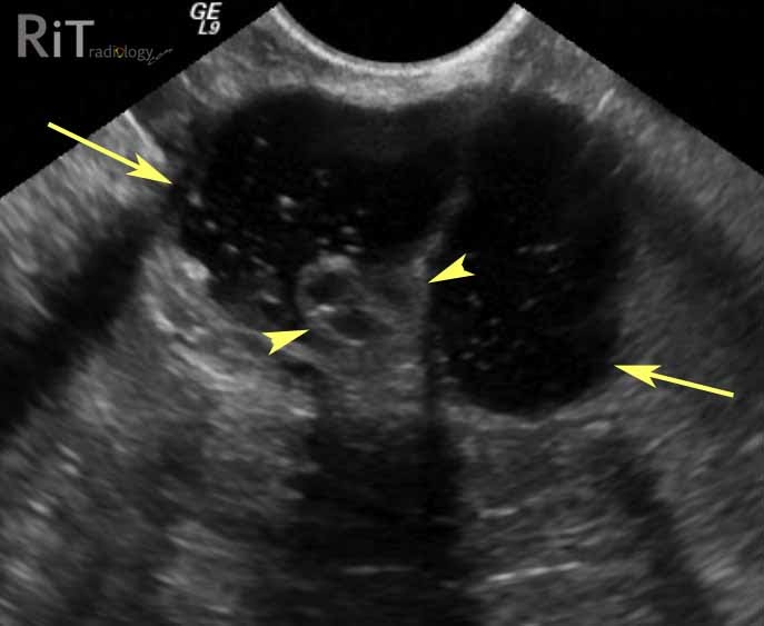 RiT radiology: Brenner Tumor of the Ovary