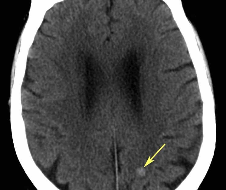 RiT radiology: Cavernoma