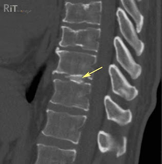RiT radiology: Intervertebral Disc Calcification