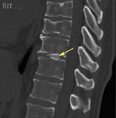 RiT radiology: Intervertebral Disc Calcification