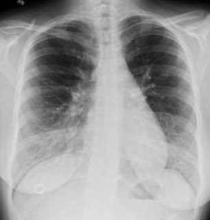 RiT radiology: ASD with PAPVR