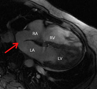 RiT radiology: ASD with PAPVR