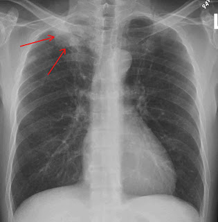 RiT radiology: Superior Sulcus Tumor