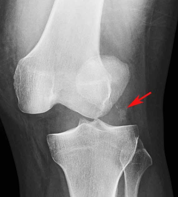 RiT radiology: Lateral Knee Dislocation