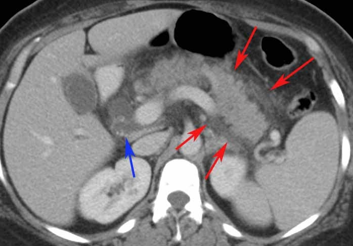 RiT radiology: Gallstone Pancreatitis
