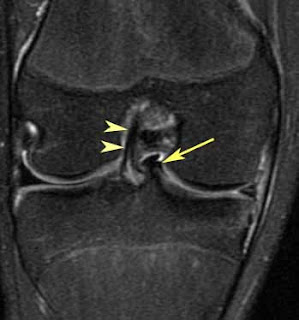 RiT radiology: Meniscal Bucket-Handle Tear