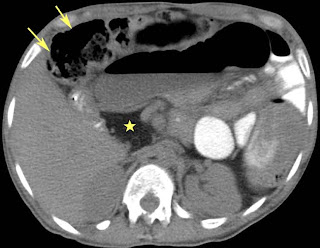 RiT radiology: Distal Intestinal Obstruction Syndrome (DIOS)
