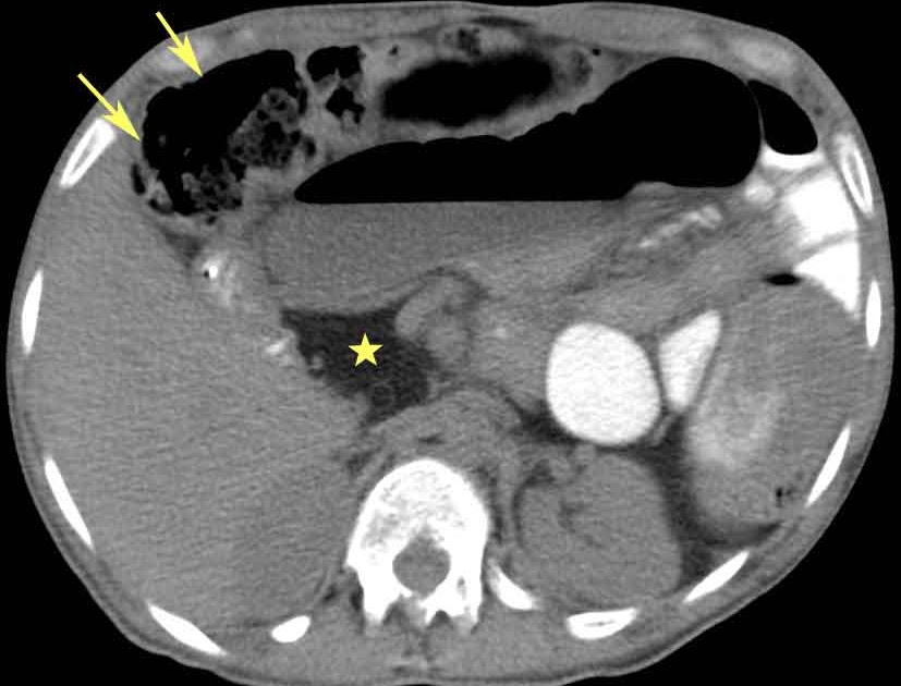 RiT radiology: Distal Intestinal Obstruction Syndrome (DIOS)