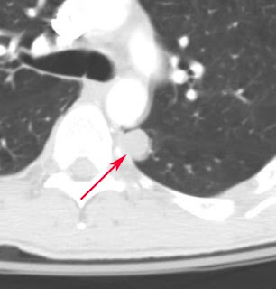 RiT radiology: Evolution of Pulmonary Laceration
