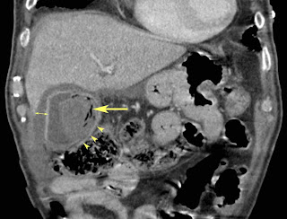 RiT radiology: Emphysematous Cholecystitis