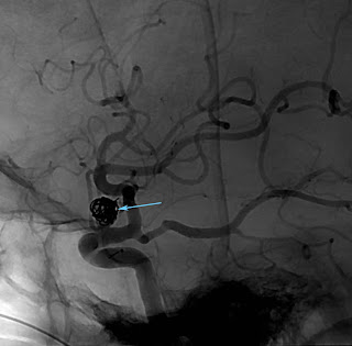 RiT radiology: Intracranial Aneurysms: Coil Embolization