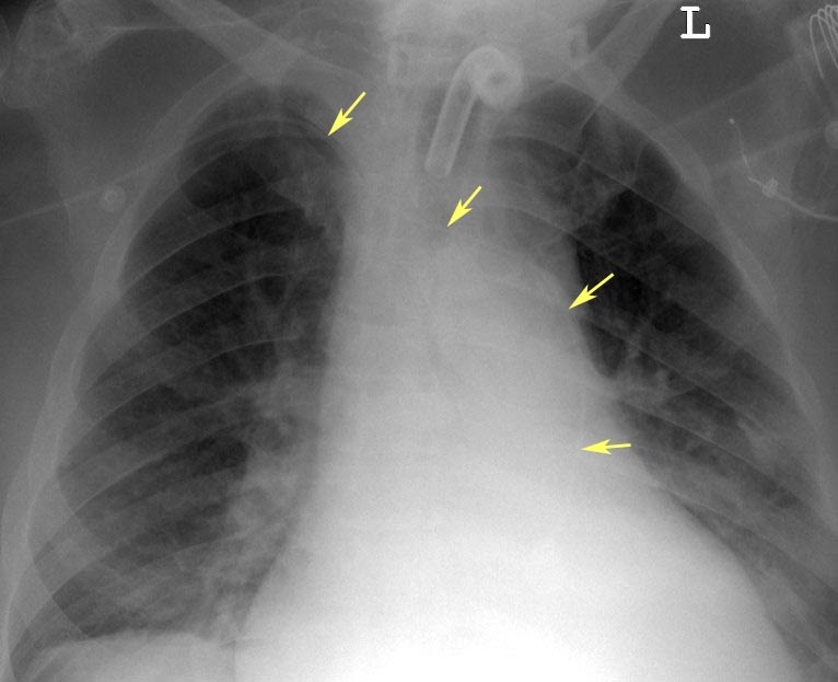 RiT radiology: Persistent Left Superior Vena Cava (SVC)