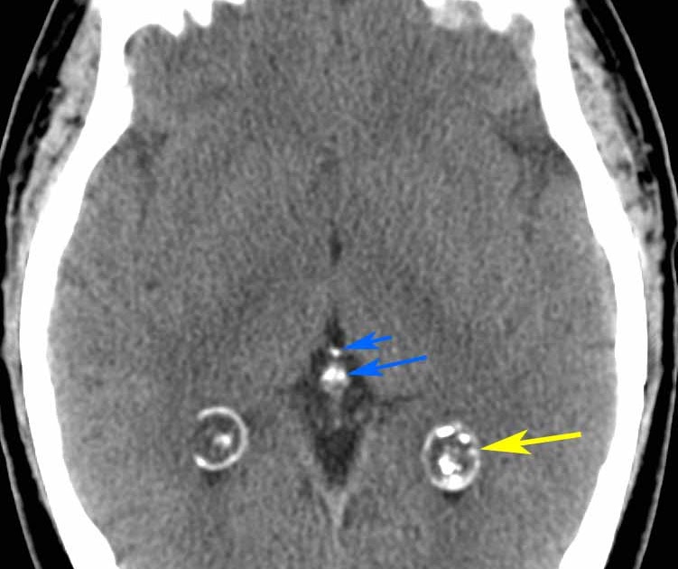 Rit Radiology Calcified Choroid Plexus Cysts