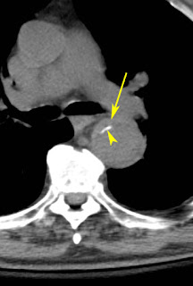 RiT radiology: Aortic Intramural Hematoma (IMH)