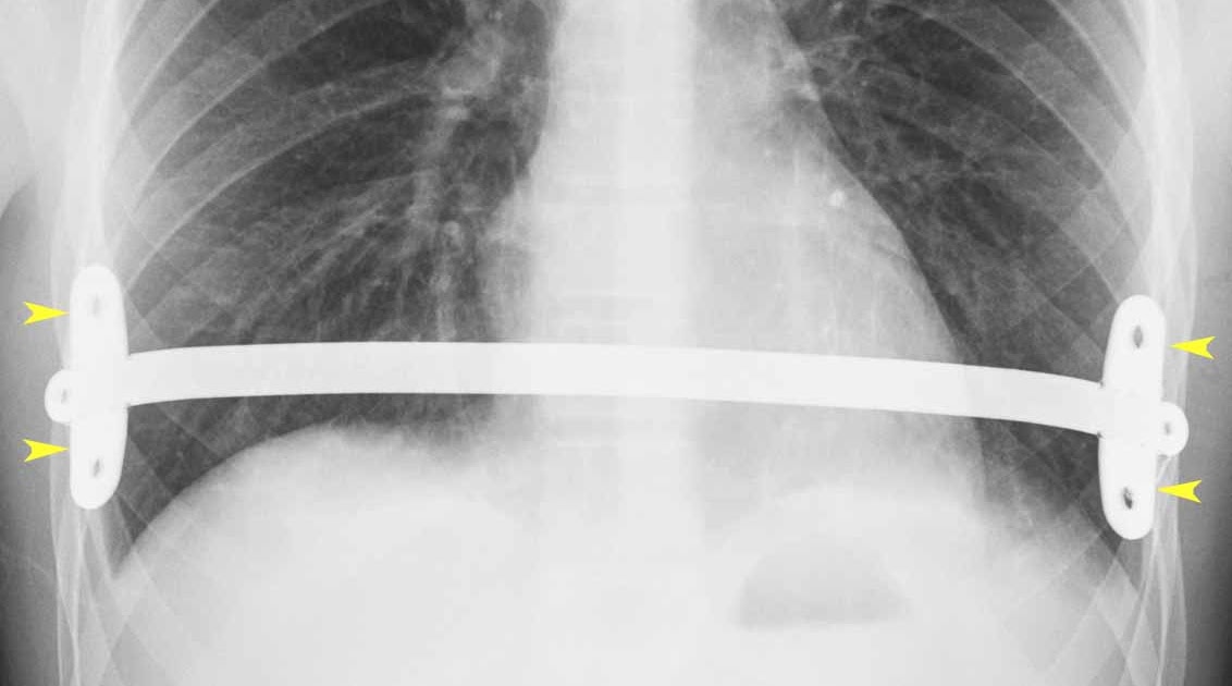 RiT radiology: Nuss Procedure for Pectus Excavatum